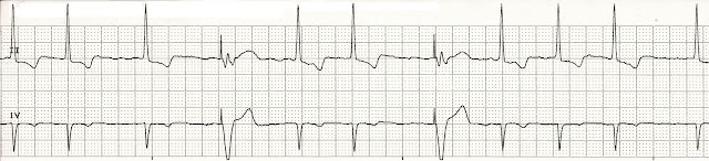 EKG Rhythm Strips 71