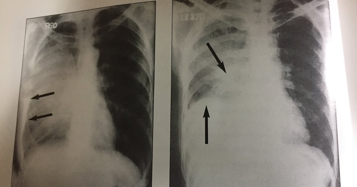 XRAYS OF THE CARCINOMA OF BRONCHUS