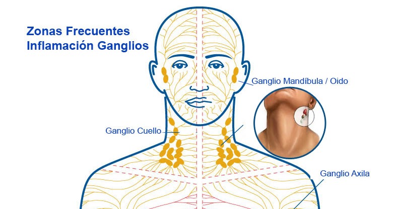 Sí, se puede: Inflamaciones / Ganglios