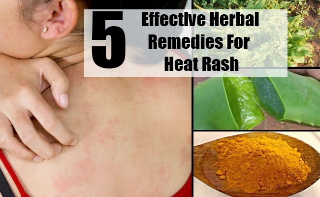 5 Effective Herbal Remedies For Heat Rash ~ Mzizi Mkavu