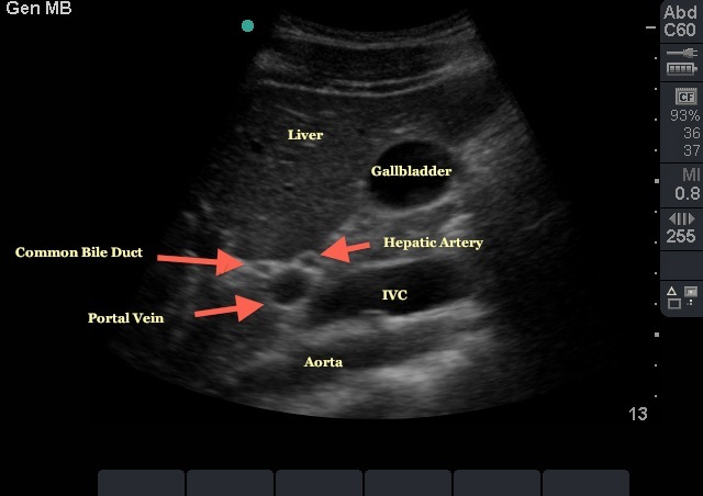 Emory Emergency Ultrasound: Follow the MLF to find the Portal Triad