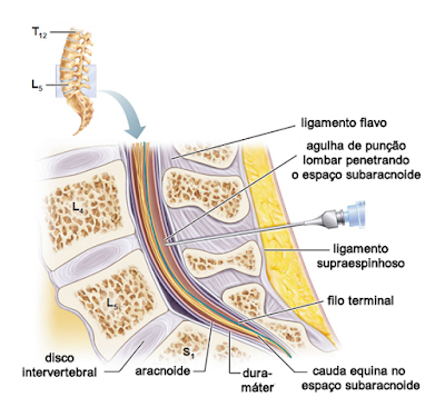 Dicas de Enfermagem: Punção lombar