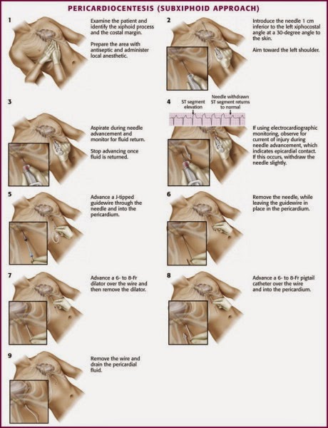 Procedures Club: Pericardiocentesis