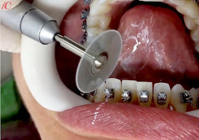 STRIPPING: Desgaste Interproximal em Ortodontia - Odonto-Tv