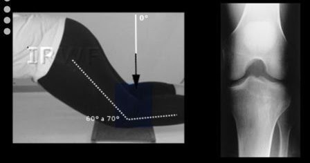 Joelho- Axial PA Tunnel View 60º - 70º