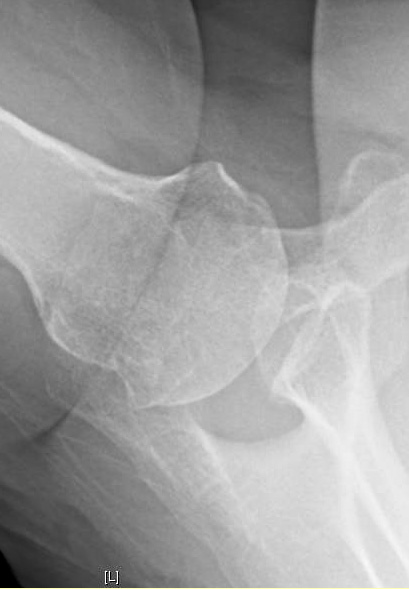 UW Shoulder and Elbow Academy: Glenoid dysplasia - evaluation and ...