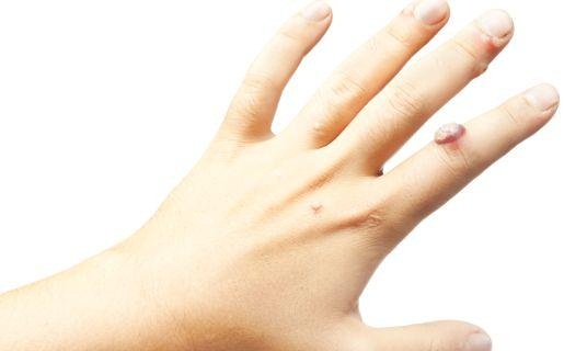 Ce que tu cherche : Que sont les verrues?