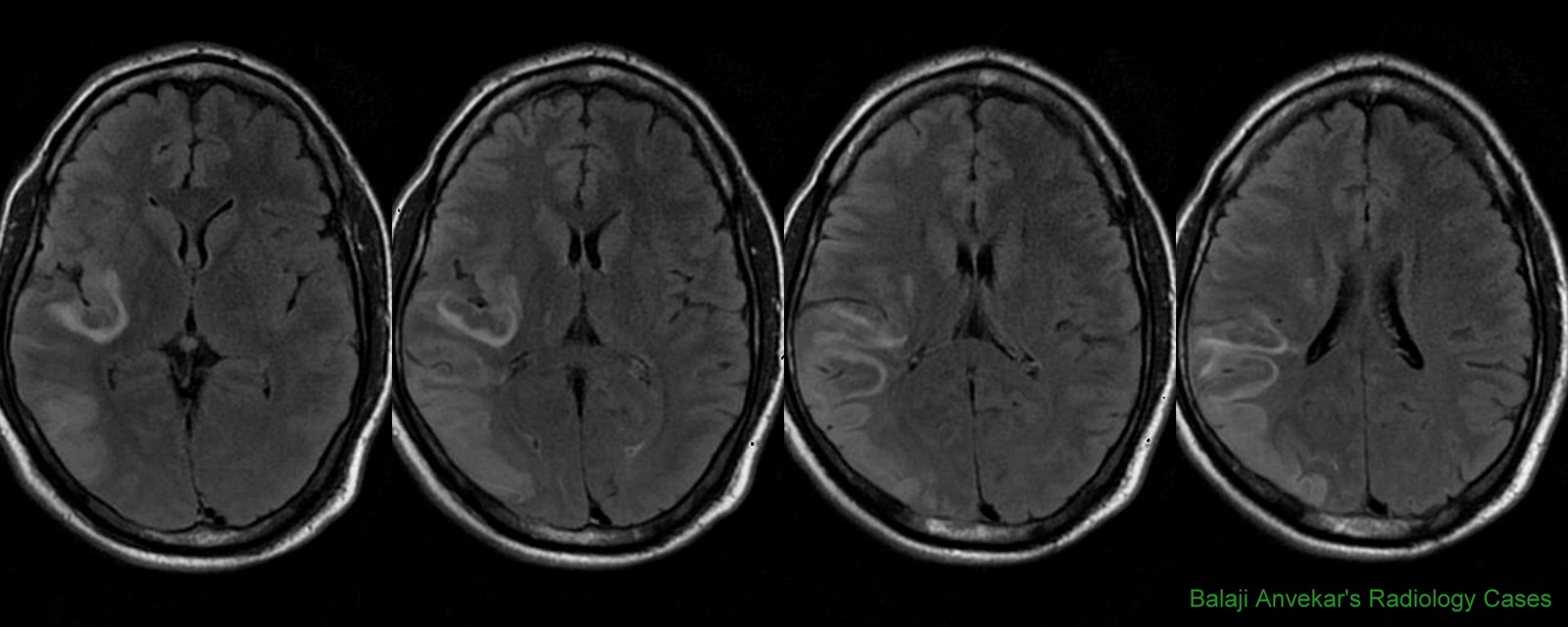 Dr Balaji Anvekar FRCR: Hyperperfusion Injury in Infarct
