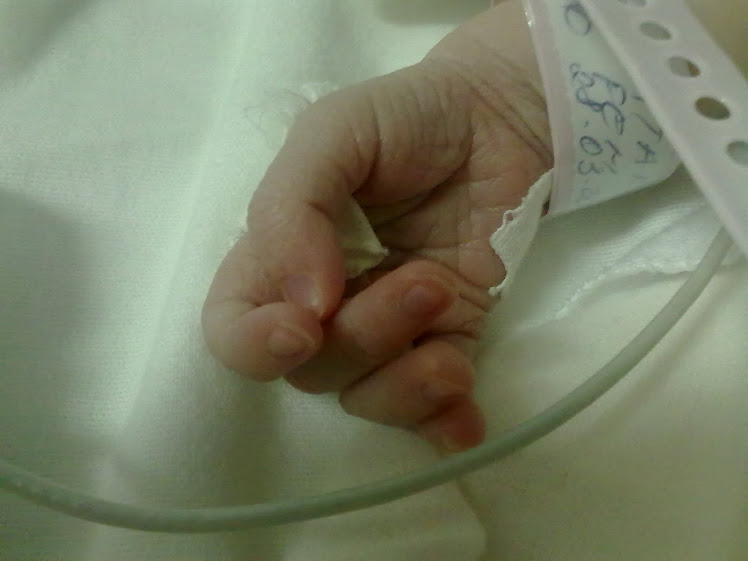 UN BLOG COMUN DESPRE ATREZIA ESOFAGULUI !: Atrezia esofagiana si ...