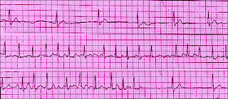 Sick Sinus syndrome | MANAGEMENT OF HEART DISEASE