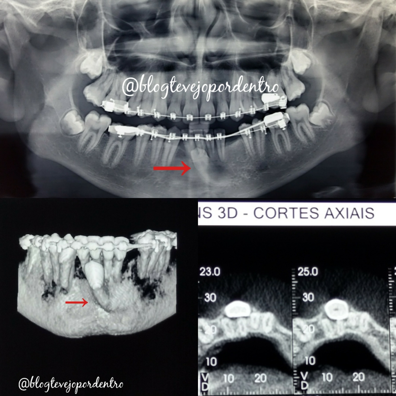 "Te vejo por dentro": Localizando dente 33 incluso