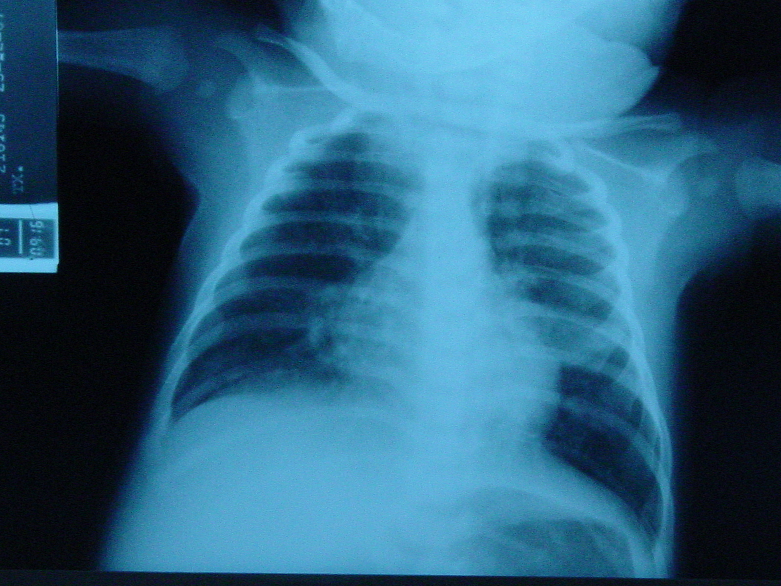 PEDIATRIA HRRB: Tratamiento Ambulatorio de la Neumonía