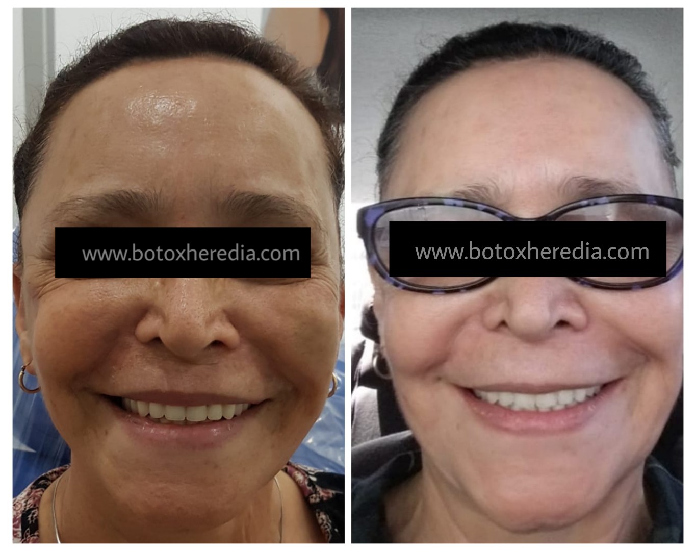 Botox, Acido Hialurónico, Bichectomia, Invisible Touch Hilos Pdo