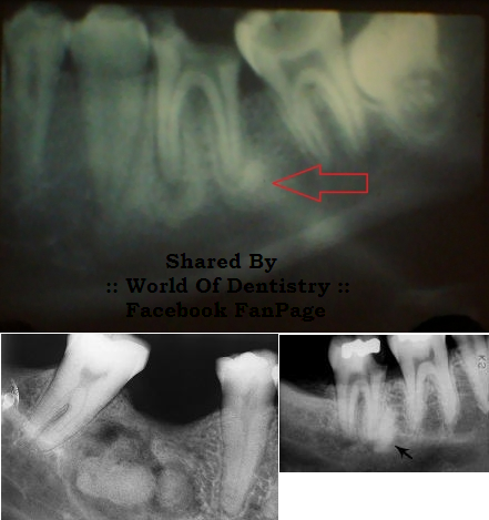 :: World Of Dentistry ::: Condensing Osteitis