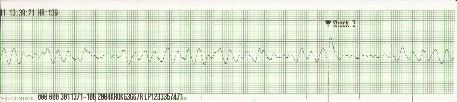 Pediatric Pulseless Ventricular Tachycardia (VT) and Ventricular ...