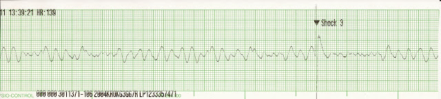Pediatric Pulseless Ventricular Tachycardia (VT) and Ventricular ...