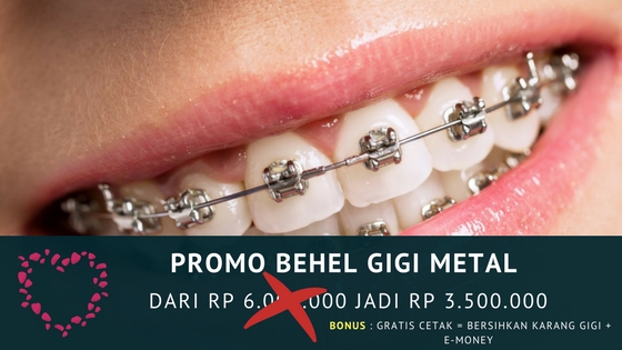 Populer 33+ Behel Keramik Vs Metal, Warna Keramik