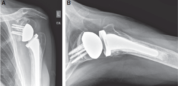 UW Shoulder and Elbow Academy: Reverse total shoulder - managing ...