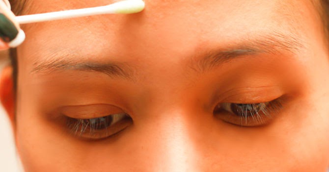 How to Get Rid of Subclinical Acne on Forehead