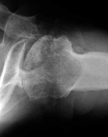 UW Shoulder and Elbow Academy: Glenoid dysplasia