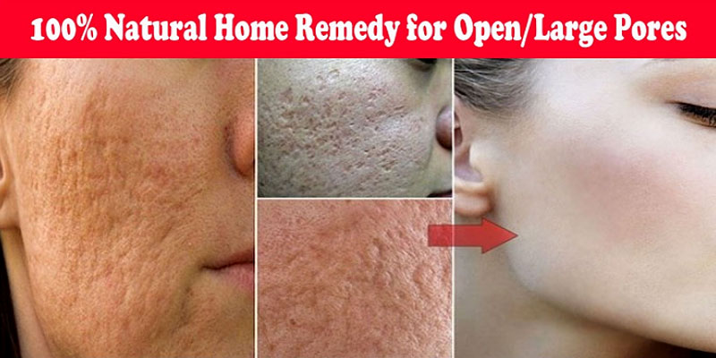 How to Fill Open Pores on Face Permanently in 3 Days Get Smooth ...