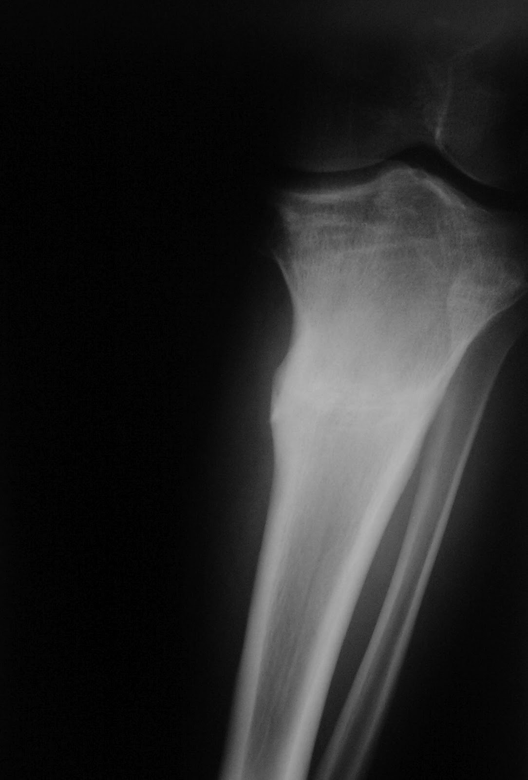 DR. CELSO RIZZI: Osteotomia de abertura gradual da tíbia proximal ...