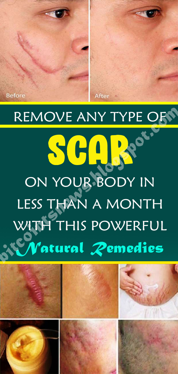 REMOVE ANY TYPE OF SCAR ON YOUR BODY IN LESS THAN A MONTH WITH THIS ...