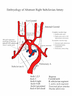 Pediatric Surgery Zone: What is the most common type of vascular rings ...