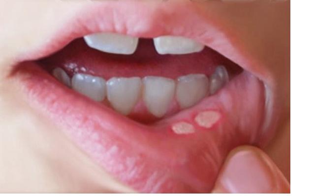 Remedios caseros: Llagas en la boca