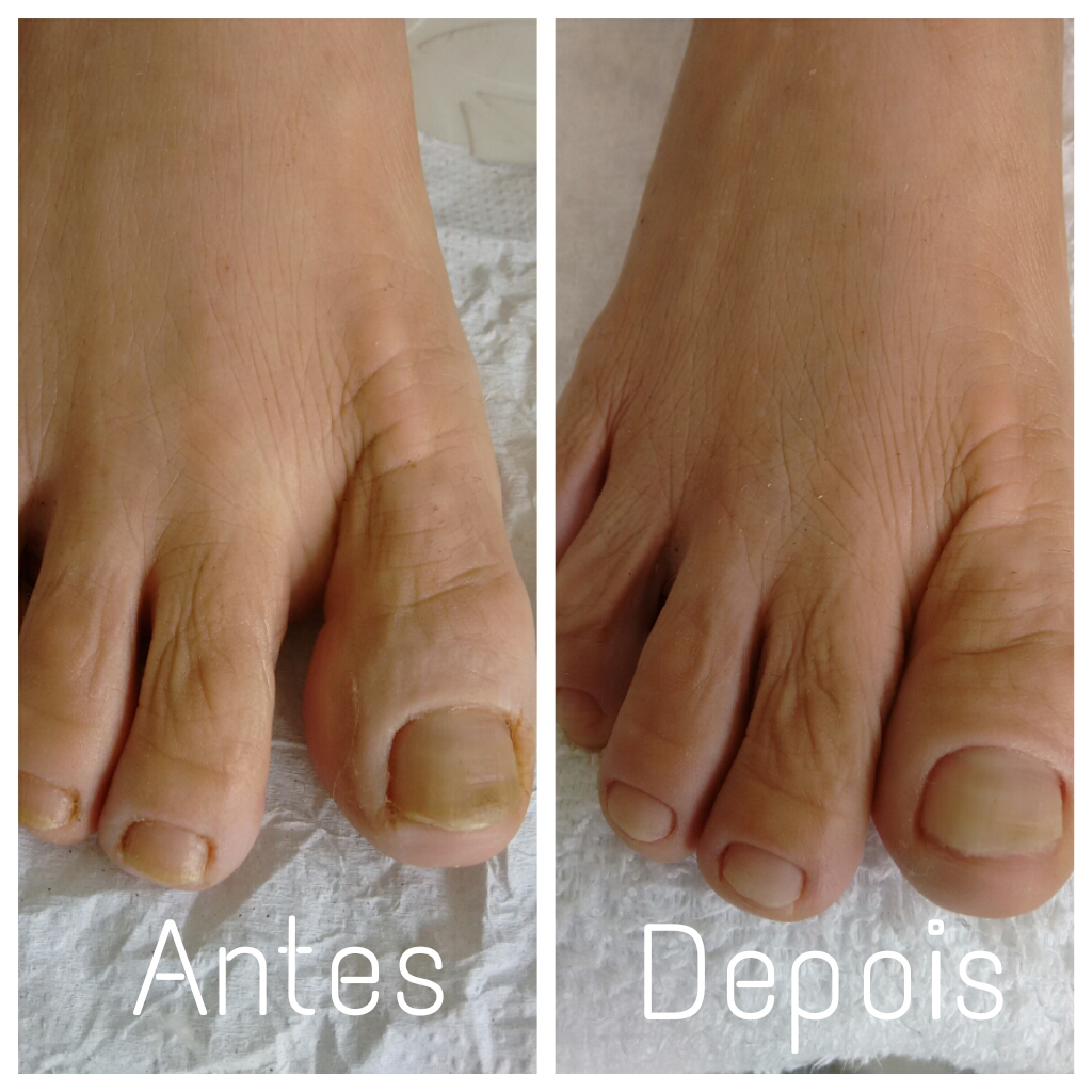 Podologia & Esmalteria Lilian Gomes: Tratamento Onicomicose