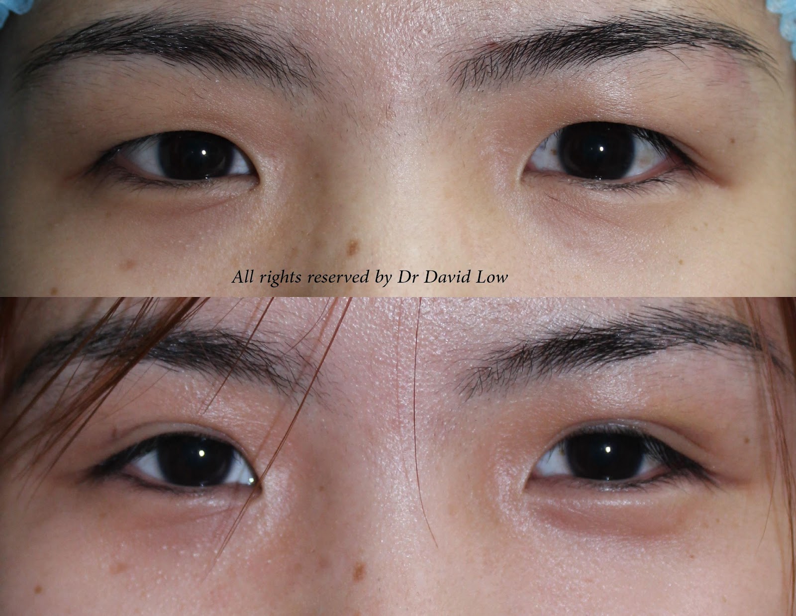 The Art & Science of Beauty : The Durable Non-cutting Double Eyelid ...