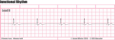 ECG Educator Blog : Junctional Rhythms