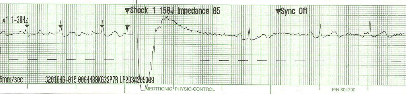 New Onset Atrial Fibrillation Part 3