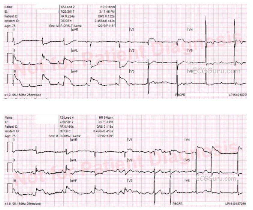 Ecg Interpretation New Guidelines To Improve ECG/EKG Interpretation In