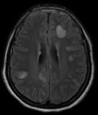 HIV Encephalopathy-MRI - Sumer's Radiology Blog