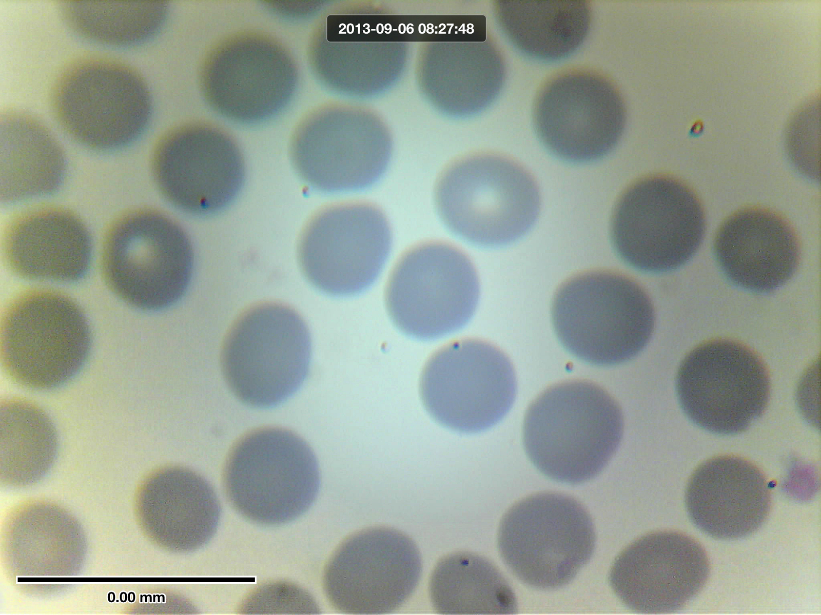 LymeMD: Blood smear of BLOs from our office lab