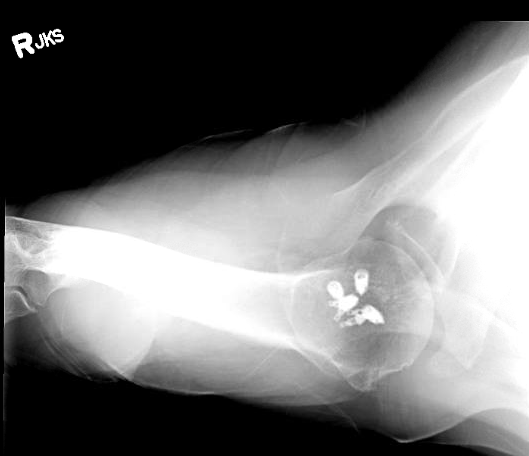 Shoulder and Elbow Surgery: Surgical treatment options for massive ...