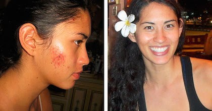 Fasting To Cure Acne - Why This Is The Quickest Proven Method To Cure ...