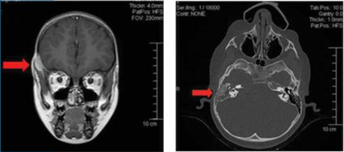 Portafolio Digital Patología Auditiva: Petrositis