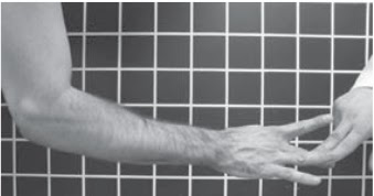 Blogão de Fisio: EPICONDILITE LATERAL