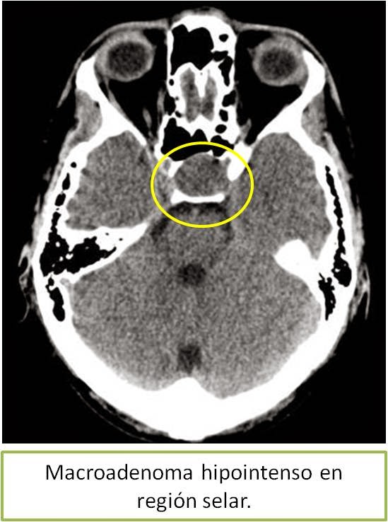 ESPE 203-2013: Patología de región selar: rol de imagenología