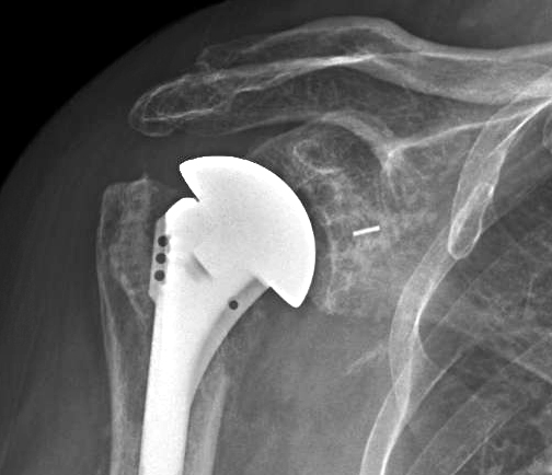 UW Shoulder and Elbow Academy: Total shoulder arthroplasty for severe ...