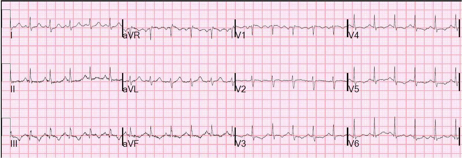 Dr. Smith's ECG Blog: April 2011