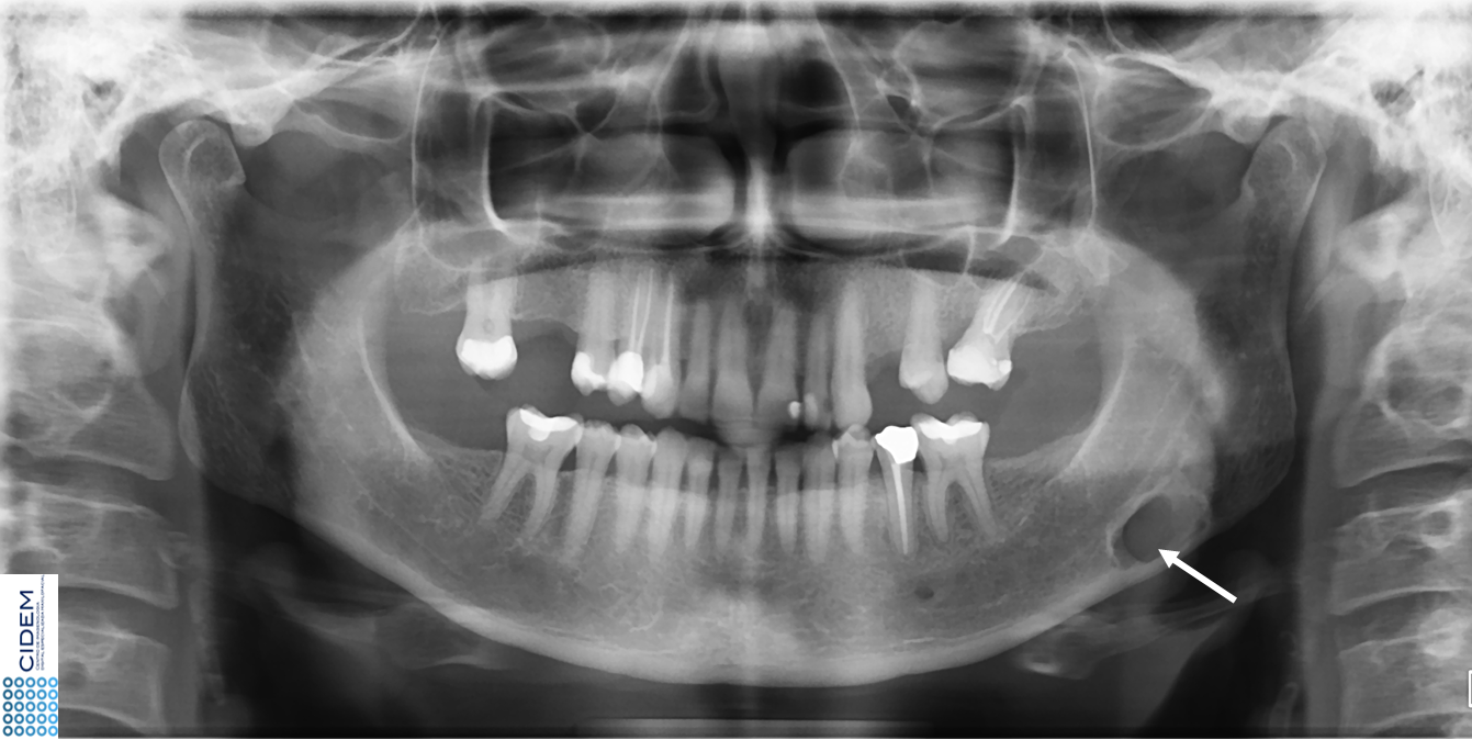 CIDEM: DEFECTO ÓSEO DE STAFNE