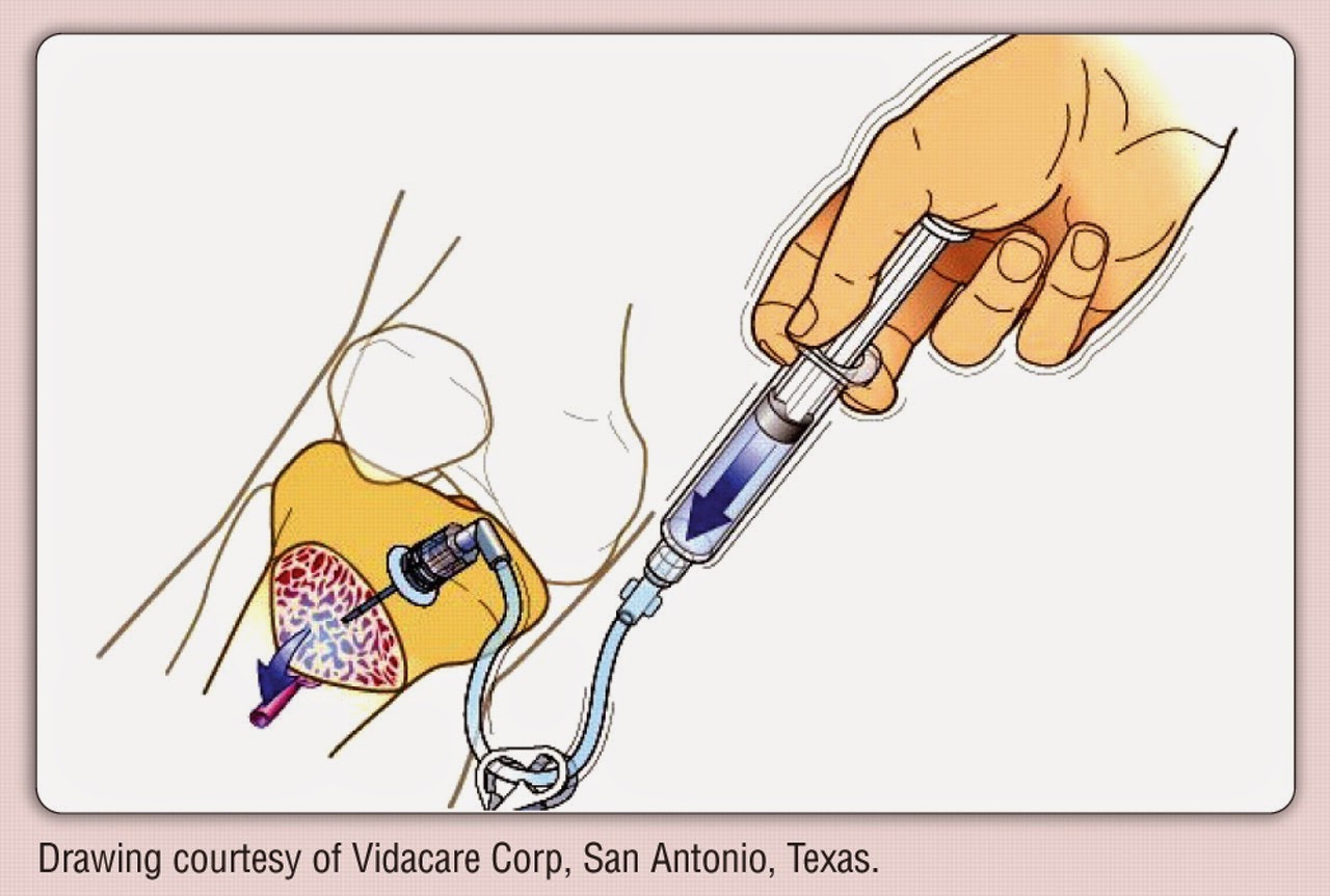Kesehatan dan Keperawatan: Prosedur Intravena