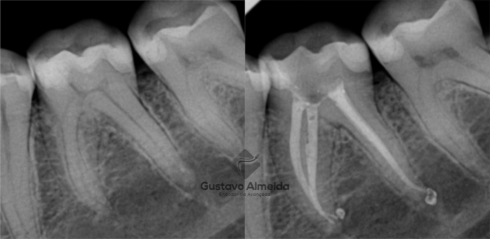PERIODONTITE APICAL - (CASO DO DIA) | Endo Gustavo Almeida
