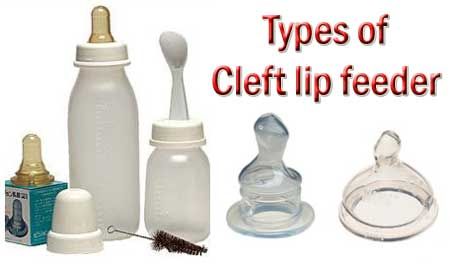 FREE CLEFT LIP AND PALATE SURGERY IN DELHI: TYPE OF FEEDING BOTTLE FOR ...
