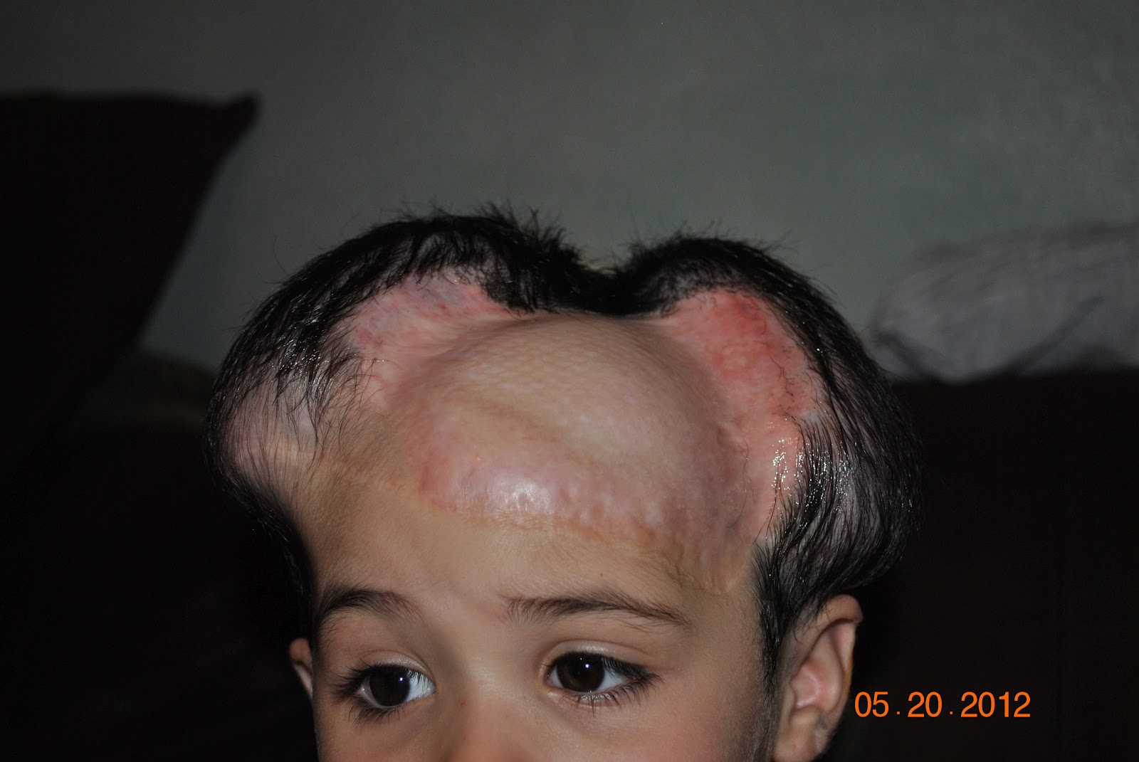 Age 4 Female Scalp Tissue Expanders: Seventeenth Filling