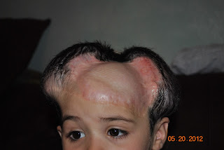 Age 4 Female Scalp Tissue Expanders: Seventeenth Filling