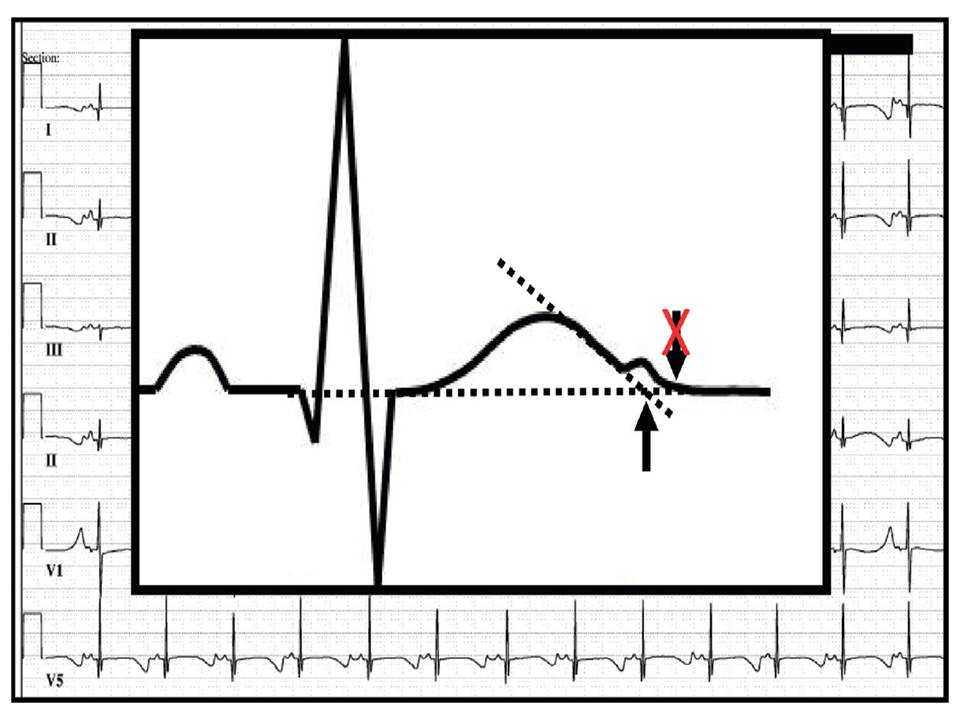 Hallazgos Anormales en ECG Atletas (II). “International recommendations ...